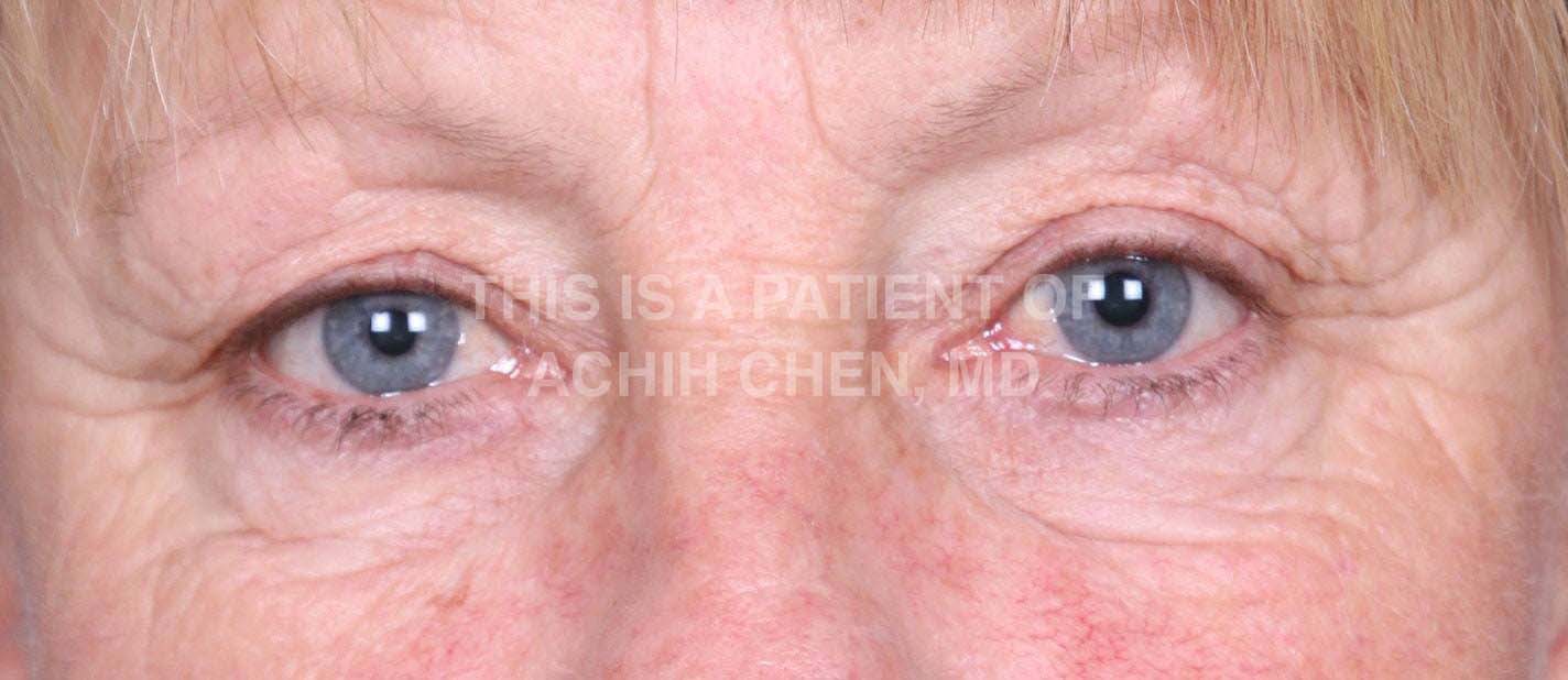 Lower Eyelid Surgery Augusta Evans Georgia, Belpharoplasty