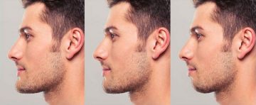 Male Facial Contouring (Implants) in Augusta | The Georgia Center