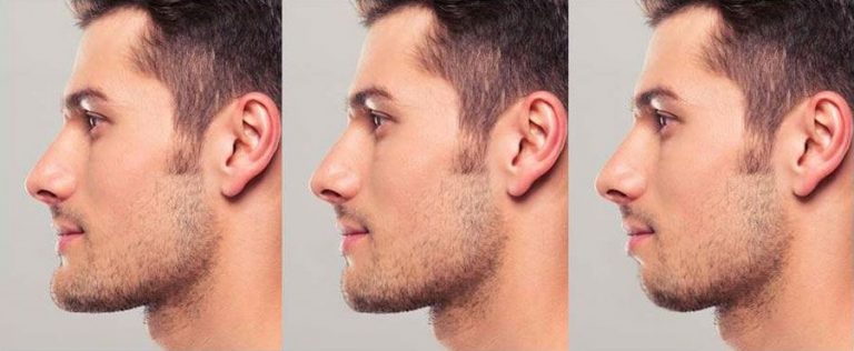 Male Facial Contouring (Implants) in Augusta | The Georgia Center