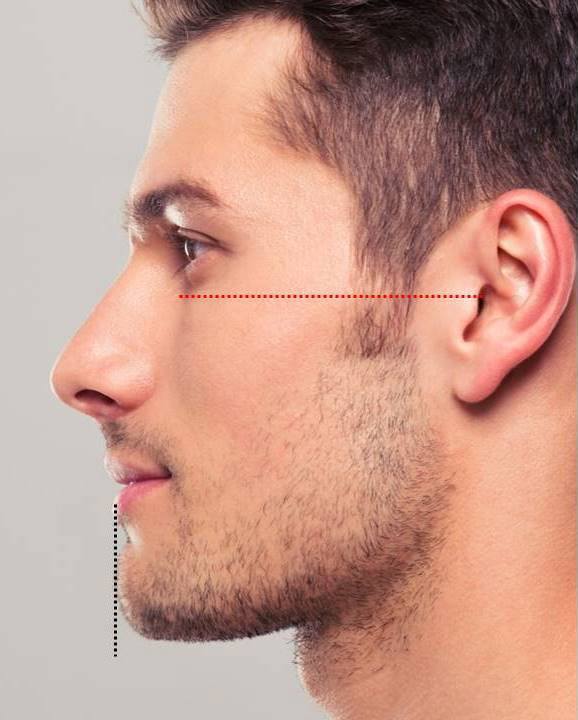 Male Facial Contouring (Implants) in Augusta | The Georgia Center