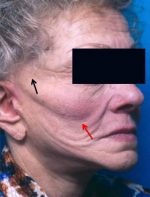 Facelift Option: Total VolumeLift® Augusta | The Georgia Center