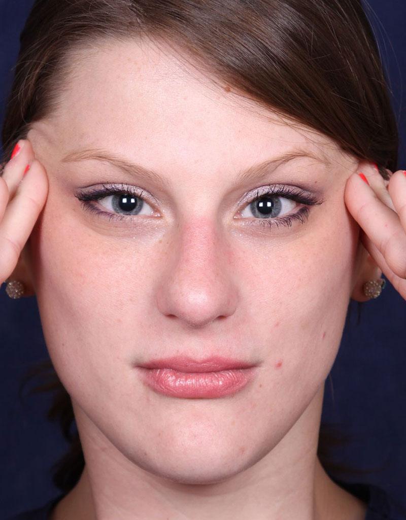 Facelift Option: Total VolumeLift® Augusta | The Georgia Center